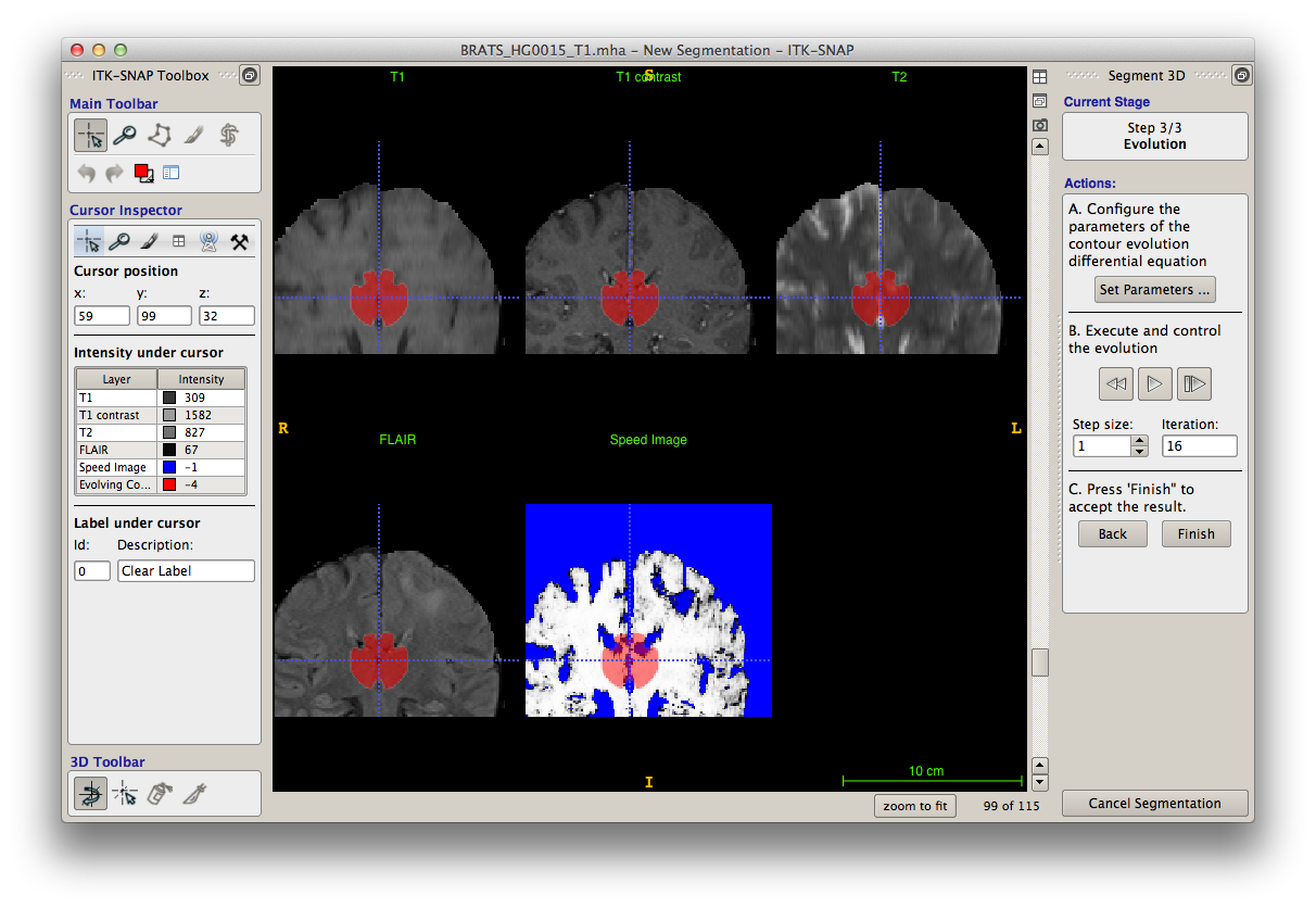 ITK-SNAP Medical Image Segmentation Tool download | SourceForge.net